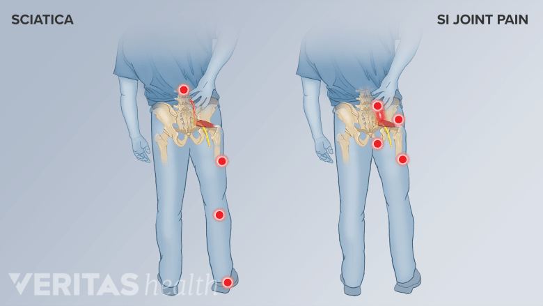 Is Sacroiliitis the Same Thing as Sciatica? | Spine-health