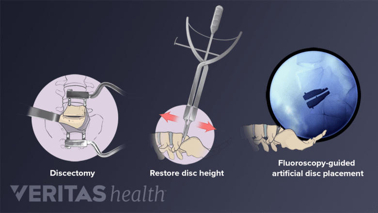 Surgery for Lumbar Degenerative Disc Disease | Spine-health