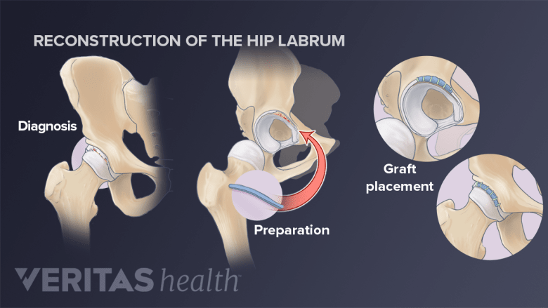 Recommended Treatments for a Hip Labral Tear | Sports-health