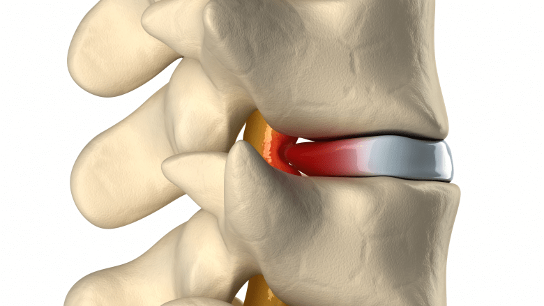 Thoracic Discs | Spine-health