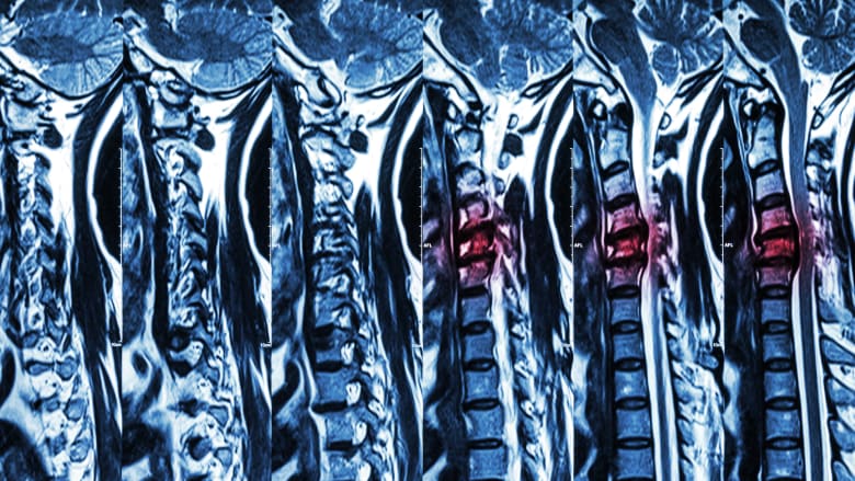 Indications and Contraindications for an MRI Scan | Spine-health