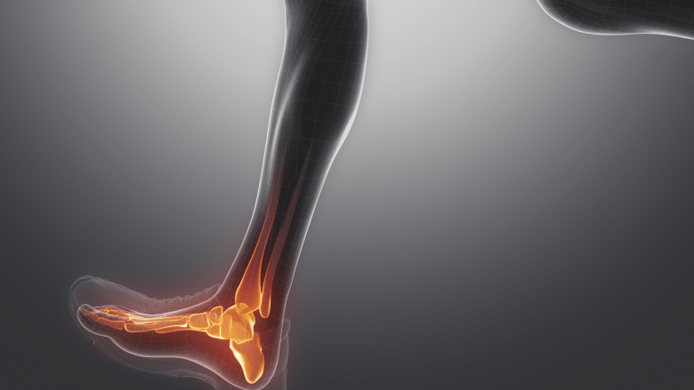 Heel Bursitis Symptoms | Arthritis-health