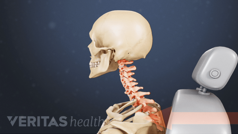 How to Treat Stiff Neck After Direct Trauma | Spine-health