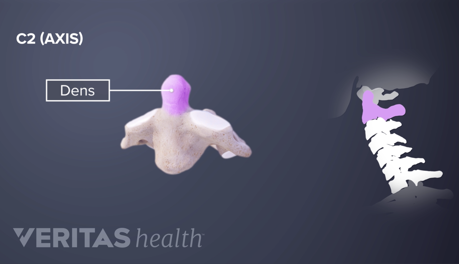 Neck Pain from Crowned Dens Syndrome | Spine-health