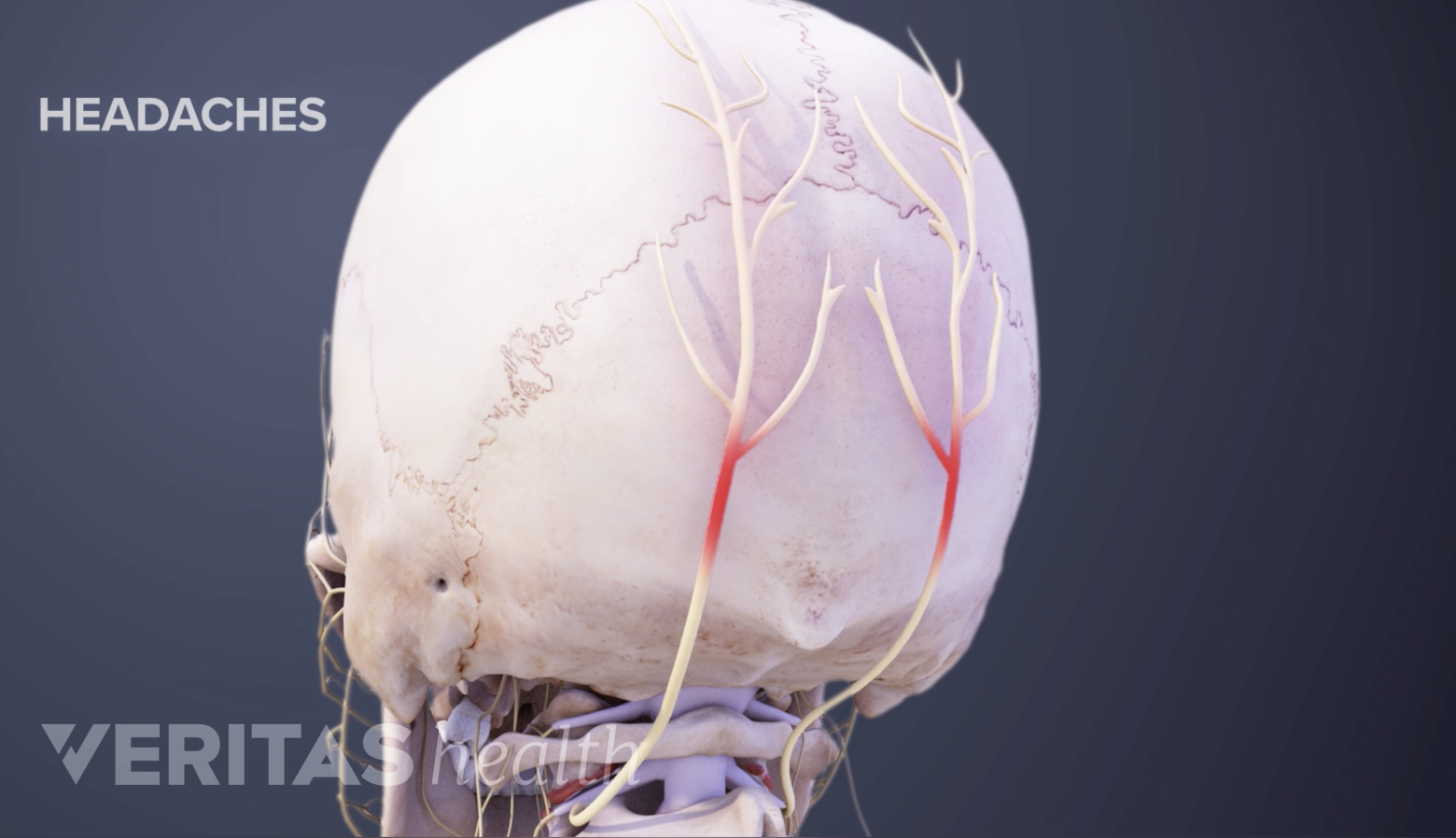 Computerized Tomography (CT) Scan with Myelogram | Spine-health
