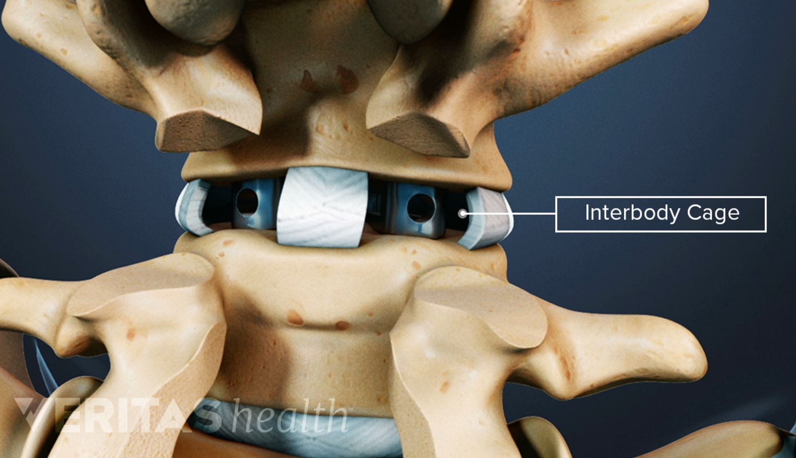 Interbody Cages for Spine Fusion | Spine-health