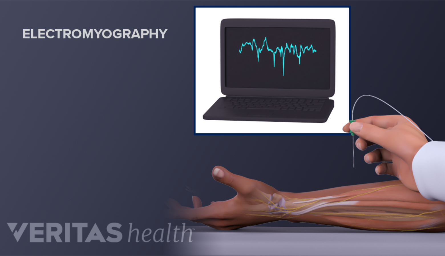 Electromyography (EMG) | Spine-health