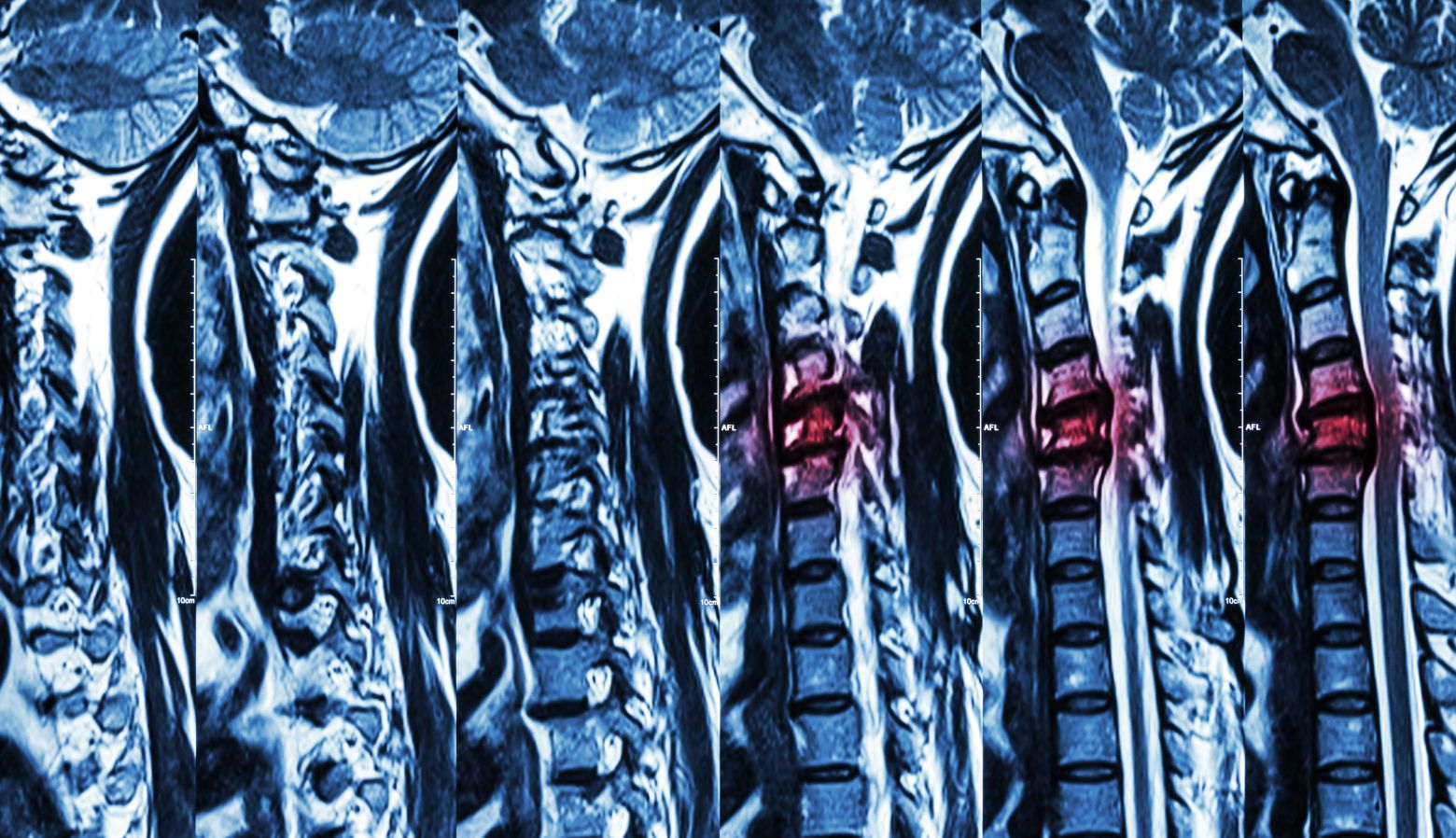 Indications and Contraindications for an MRI Scan | Spine-health