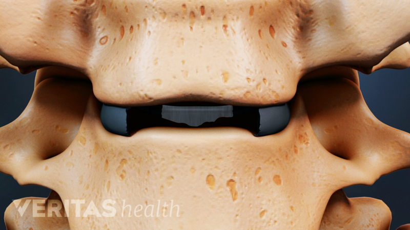 Artificial Disc Replacement | Spine-health