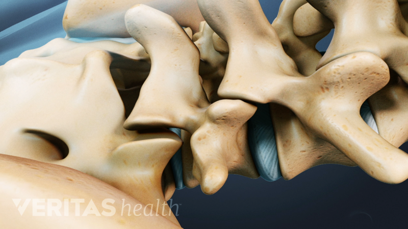 Artificial Disc Replacement | Spine-health