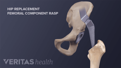 Hip Surgery | Arthritis-health