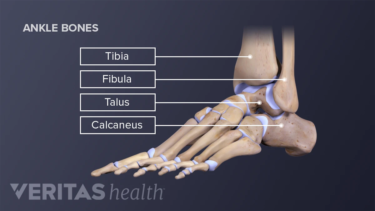 Anatomy Of A Heel Haglund's Deformity: Causes, Symptoms & Treatment