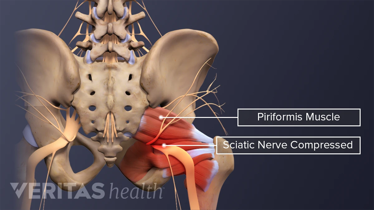 Piriformis Syndrome Causes