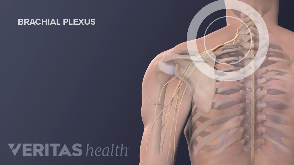 Brachial Plexus Injury Symptoms Erb's Palsy: Symptoms, Causes
