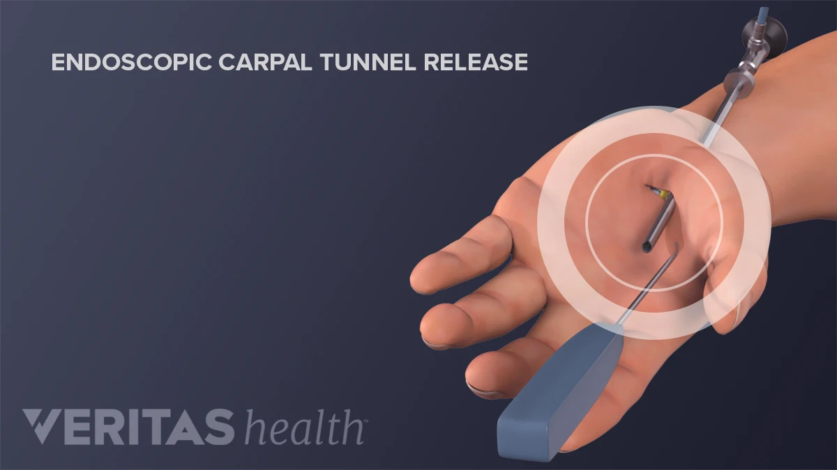 Carpal Tunnel Syndrome Surgery Endoscopic