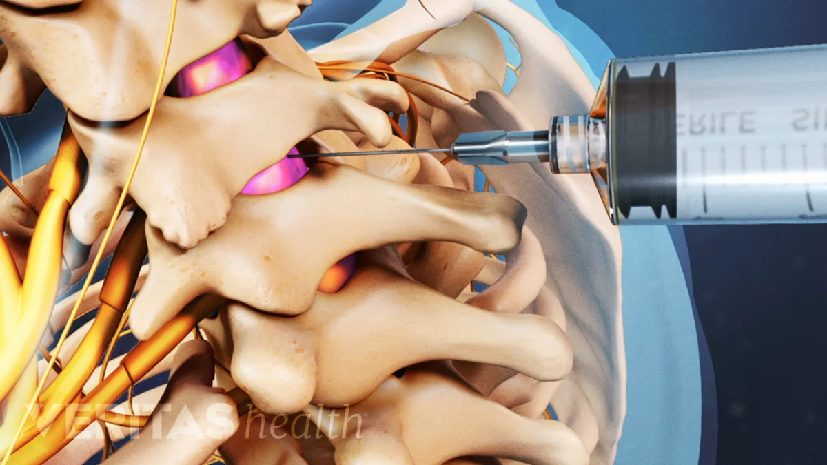 Cervical Spine Epidural Injection Back Pain Epidural Injection