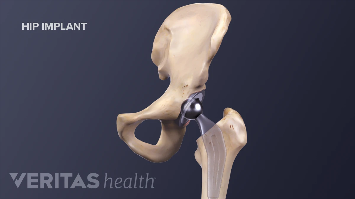 Hip Joint Replacement Our Guide To Recovery From Hip Replacement