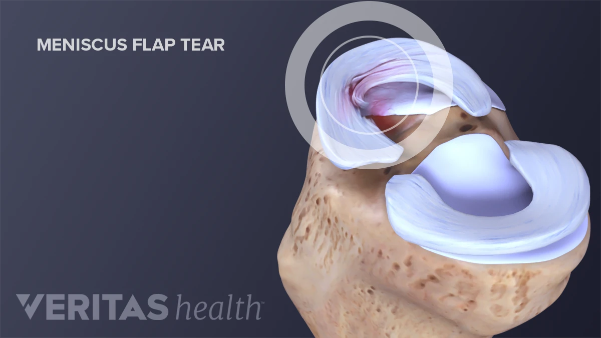 Tear Meniscus Examination Meniscus Tears Golden State Orthopedics