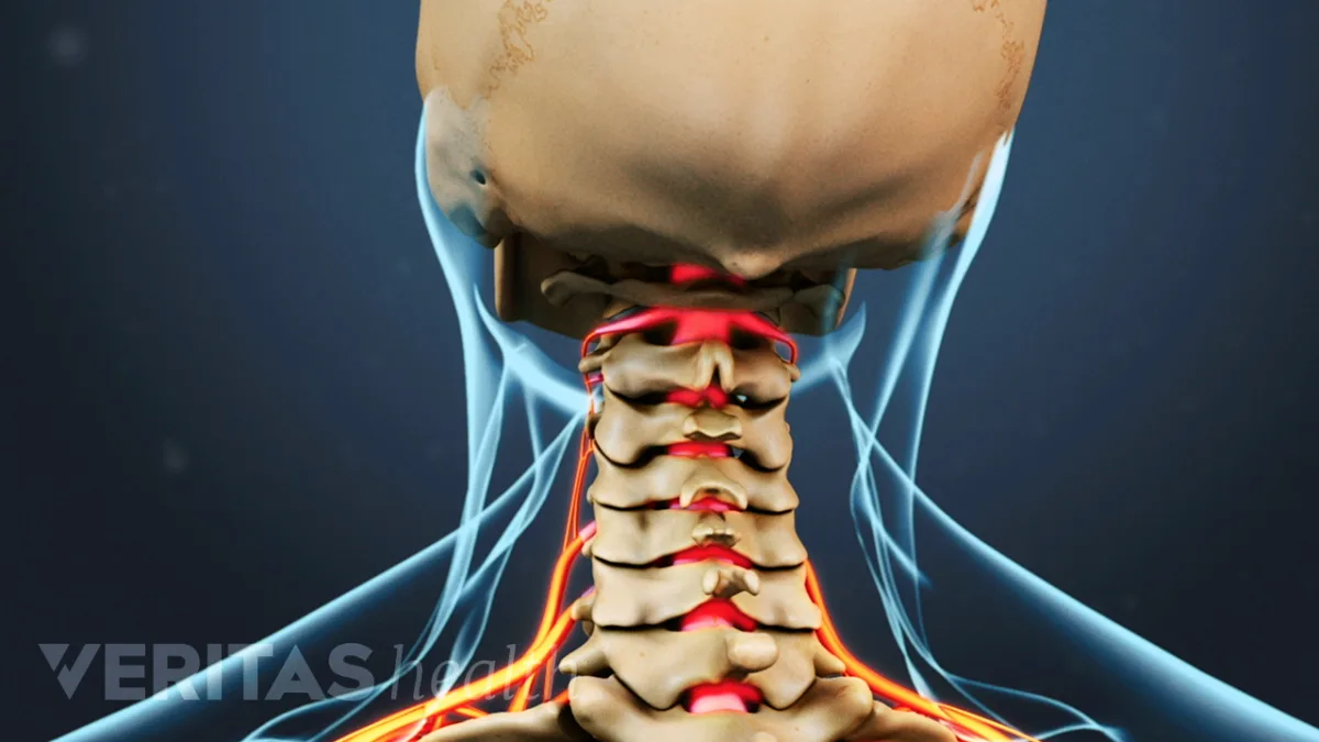 Cervical Spine Nerve Damage Pinched Nerve – Dynamic Spine