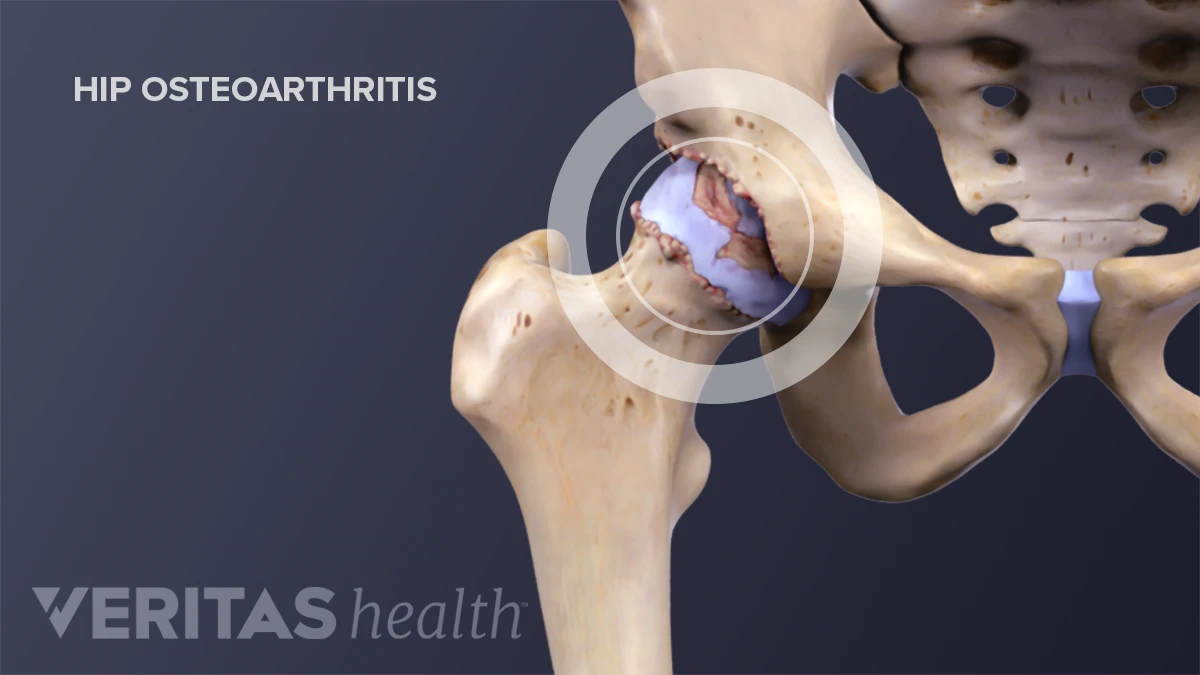Osteoarthritis Hip New Procedure Helps Patients Avoid Hip Replacement,