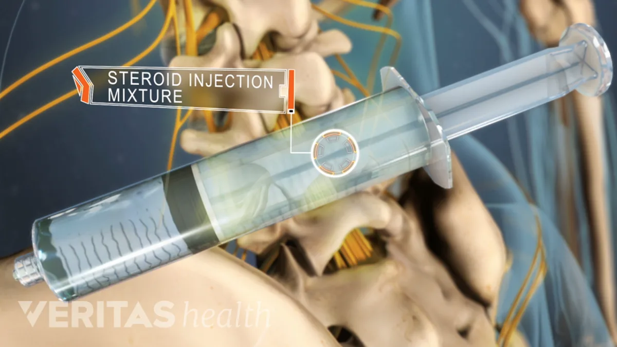 Epidural Steroid Injection Needle Cervical Epidural Steroid Injection