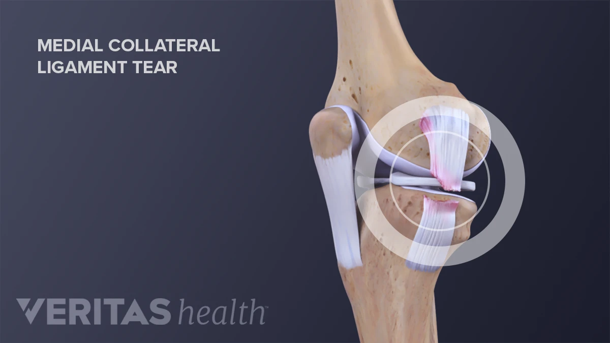 Tibial Medial Collateral Ligament Medial Collateral Ligament (MCL)