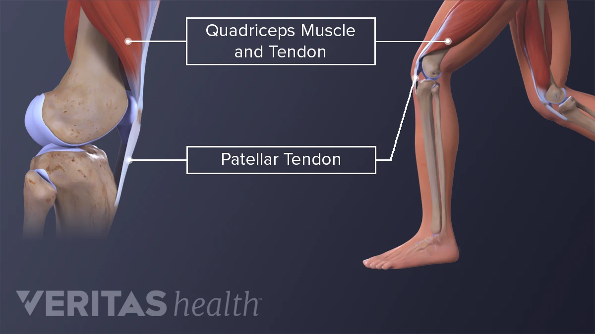 Quadricep Tendon Pain