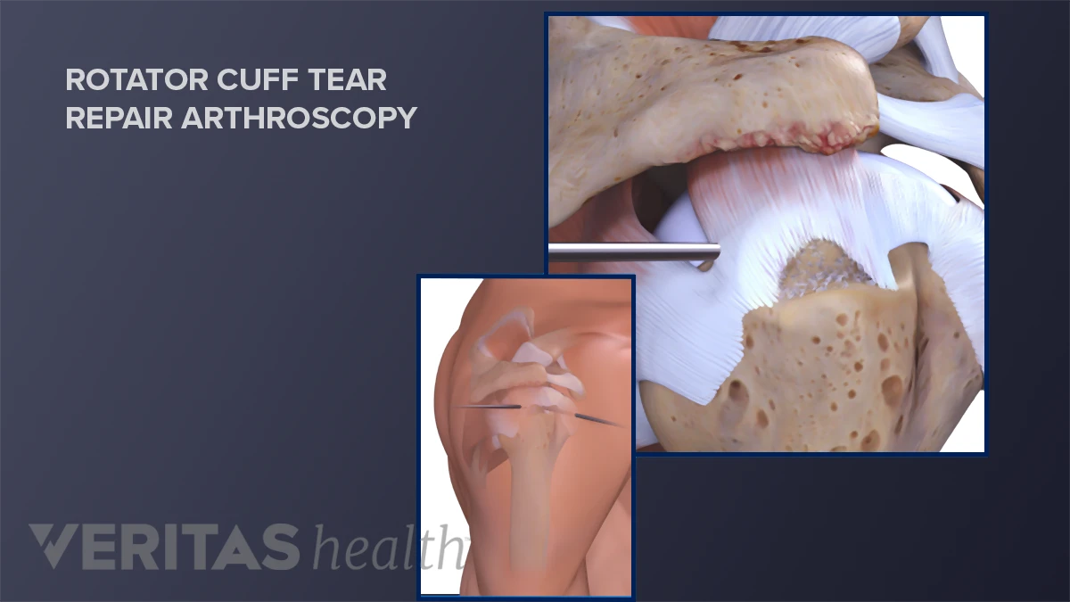 Rtc Tear Rotator Cuff Tear Rotator Cuff Tears Rotator Cuff Tear Rehab
