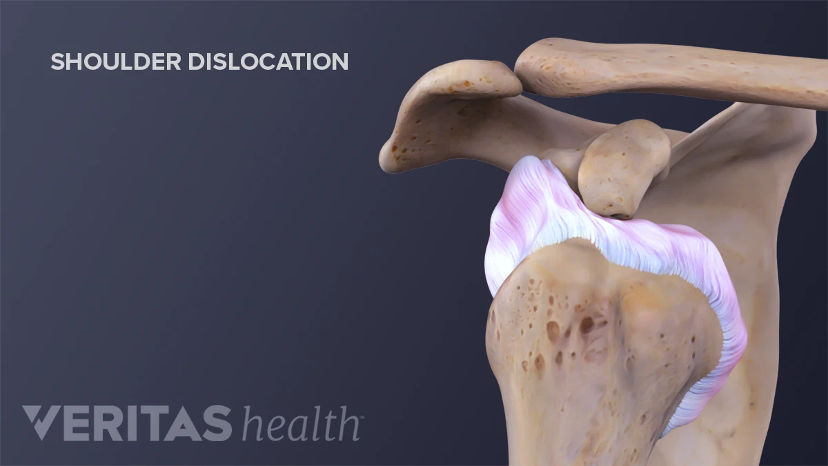 Anterior Shoulder Dislocation MSK | Something About Radiology – Just