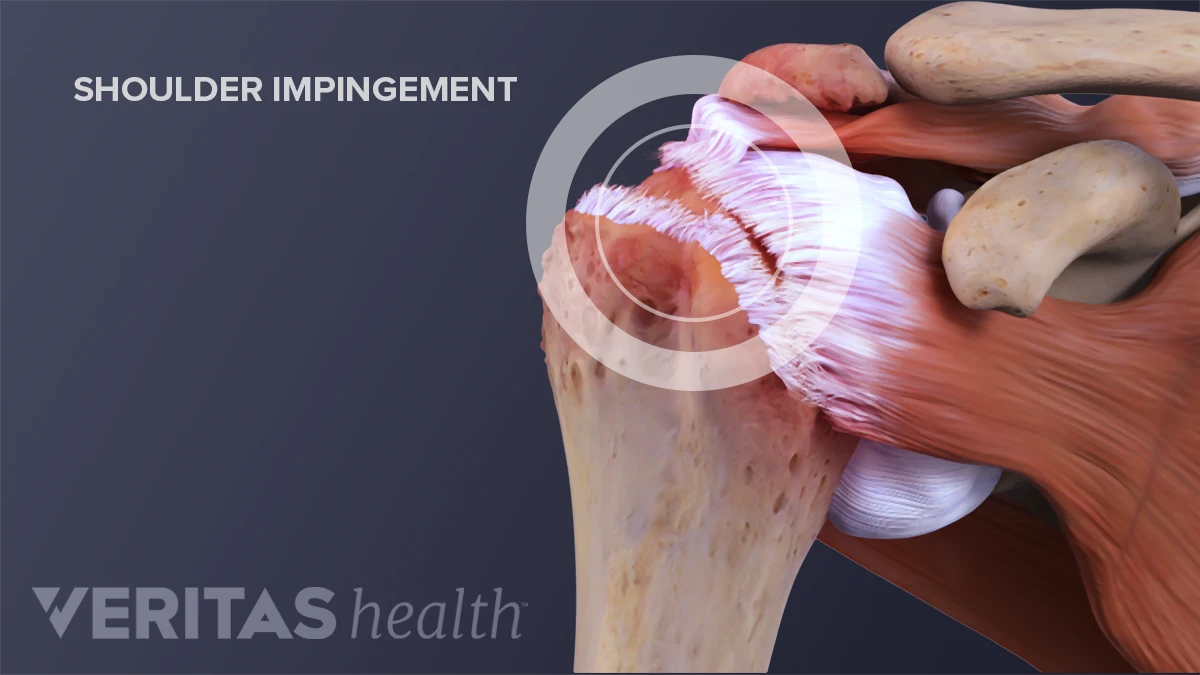 Mix Shoulder Impingement Syndrome Symptomscauses