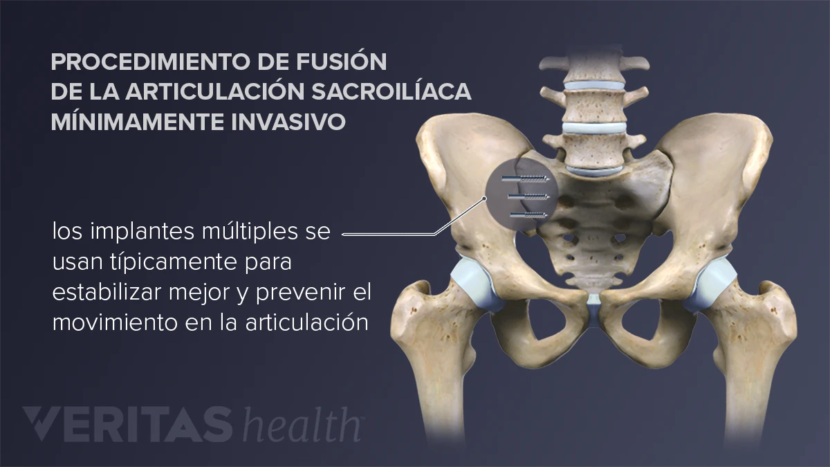 Anatomía De La Articulación Sacroilíaca Proyecciones Articulaciones