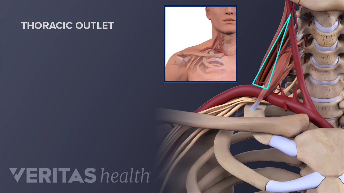 Thoracic Outlet Syndrome Pain Vascularandveincenter | Thoracic Outlet