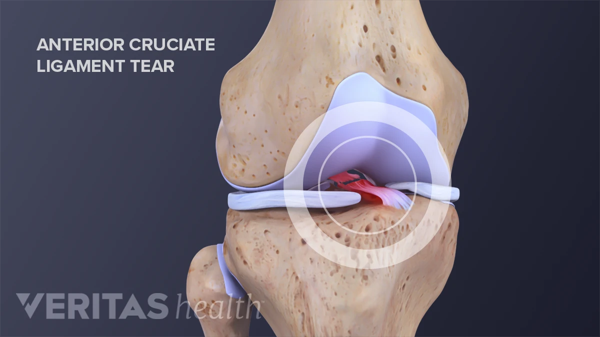 Acl Anterior Cruciate Ligament Injury Sportnova Uk