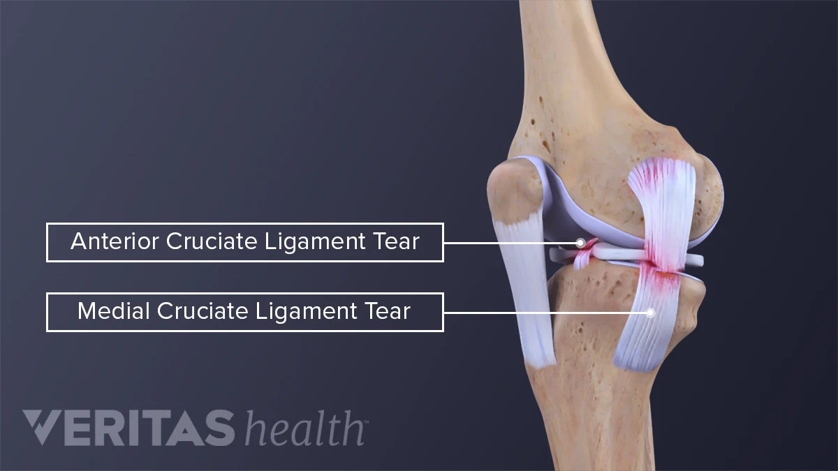 Mcl Knee Injury Overcome Medial Collateral Ligament Injury