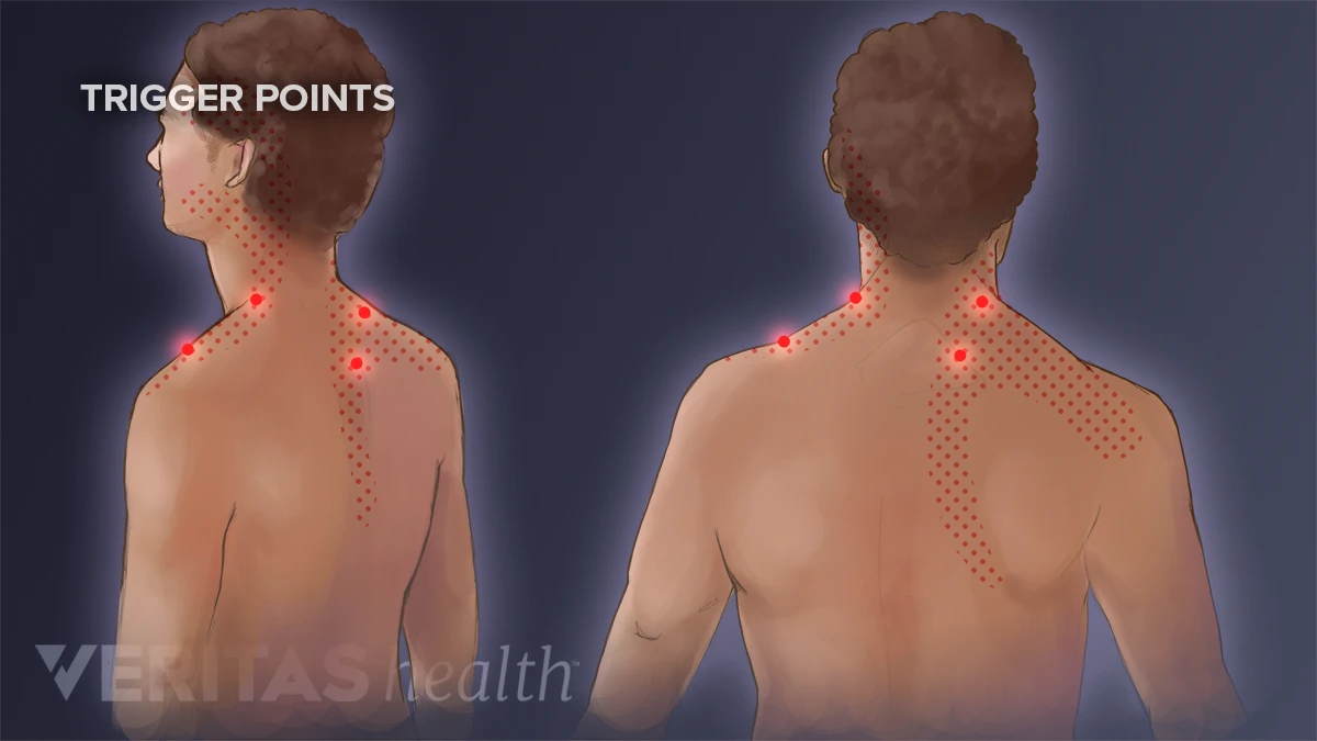 Cervical Trigger Points 5 Pressure Points For Neck: Treat Neck Pain