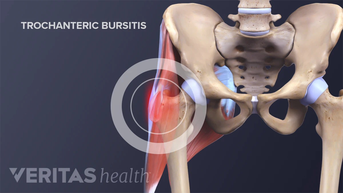 Greater Trochanteric Bursitis A Common Cause Of Hip Pain What Is
