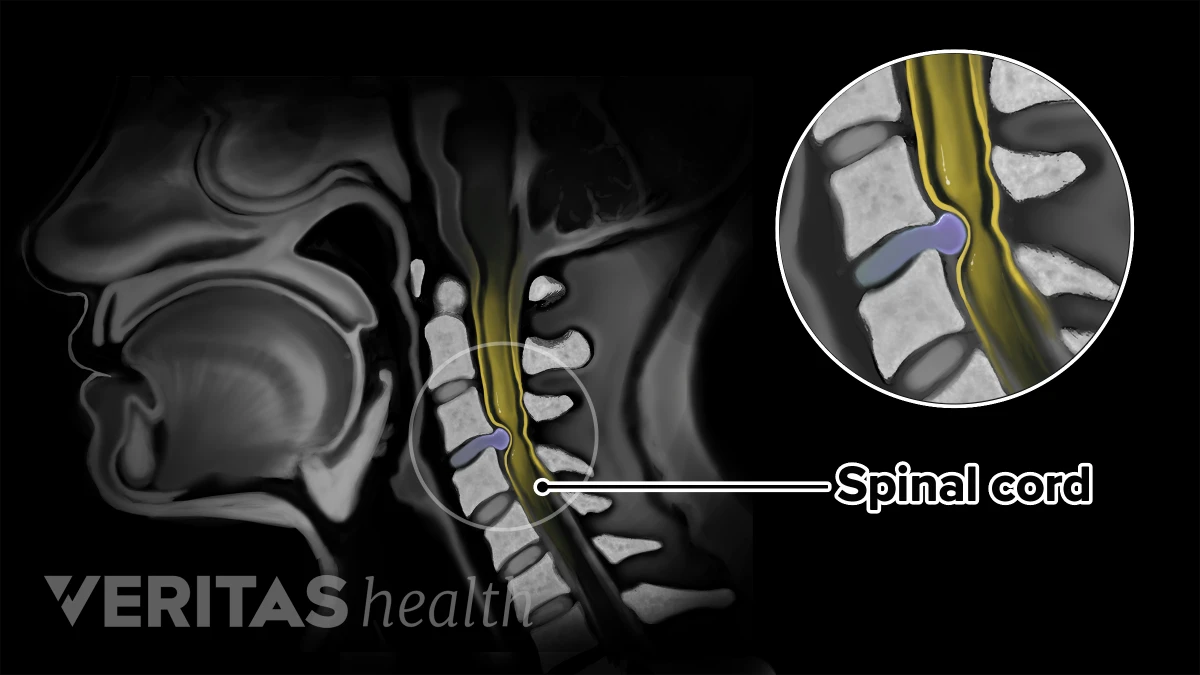 Cervical Spondylosis How To Cure Cervical Spondylosis? Causes,