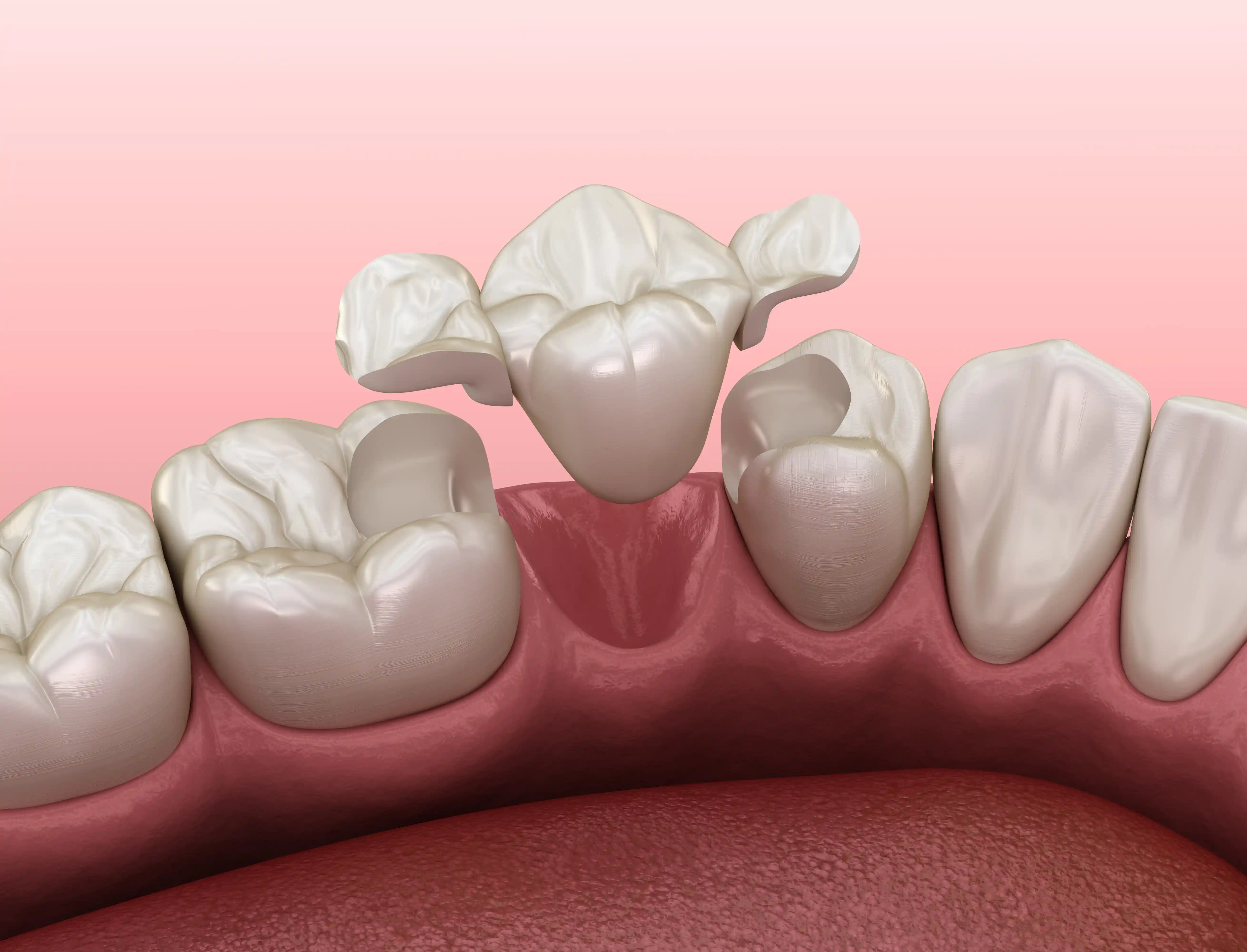 Maryland Bridge London | Resin Bonded Bridge | From £515 | South Kensington