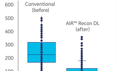 AIR Recon DL for consistent image quality and exam time reduction