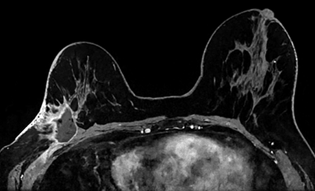 Delivering resolution, speed and comfort in MR breast imaging at ...