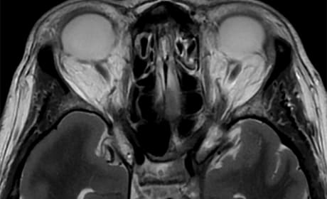 High spatial resolution imaging for the depiction of microadenoma in ...
