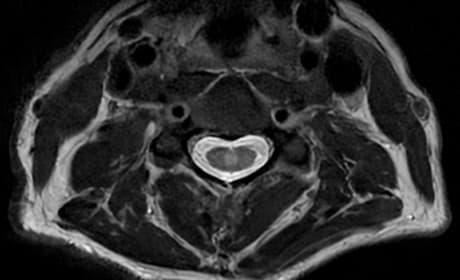 Addressing the issue of motion and low SNR in cervical spine imaging