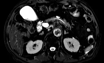 Thin-slice, high SNR DWI for detection of left lobe liver tumors