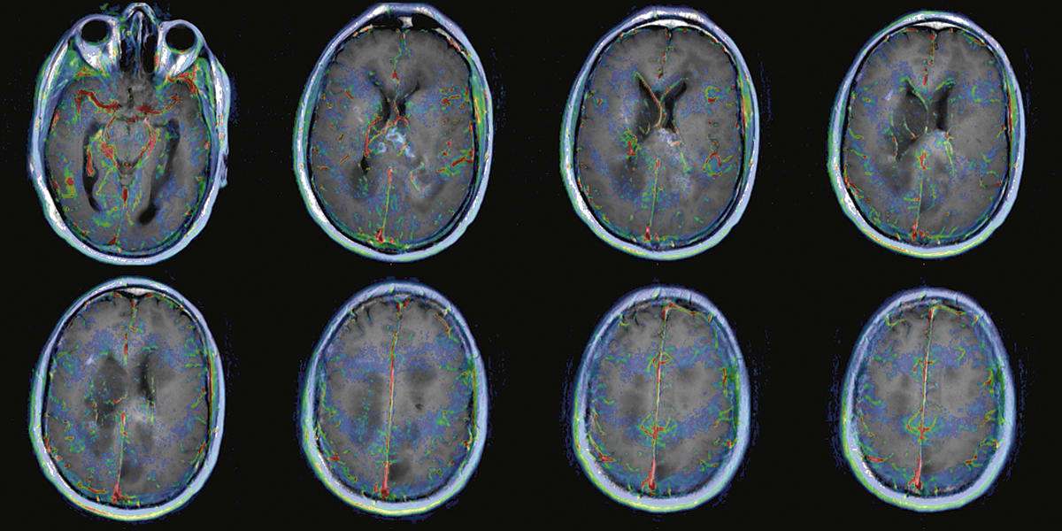 Multiparametric, multi-tracer PET/MR in the brain