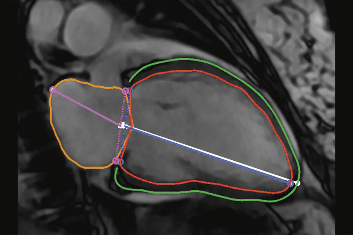 Advanced cardiac imaging with AI changes patient treatment