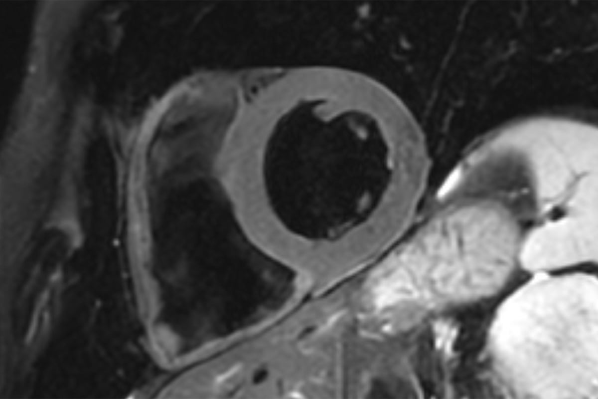 The clinical benefits of AIR Recon DL for MR image reconstruction