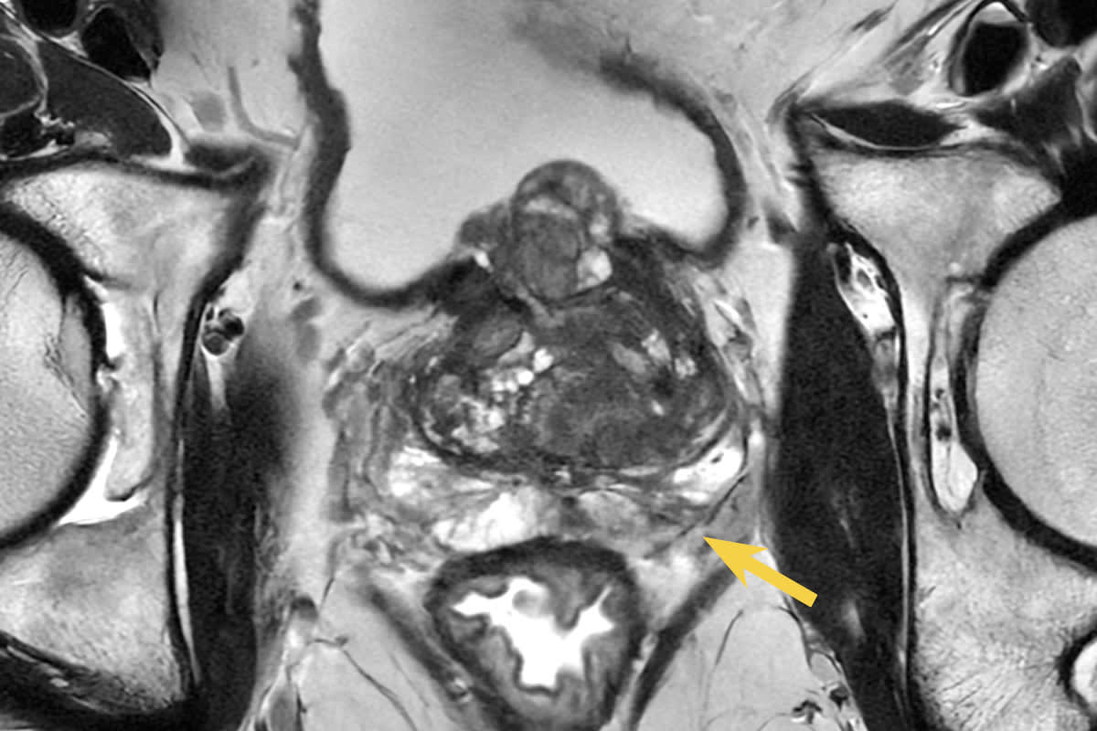 Advances In Multiparametric Prostate Mr Imaging