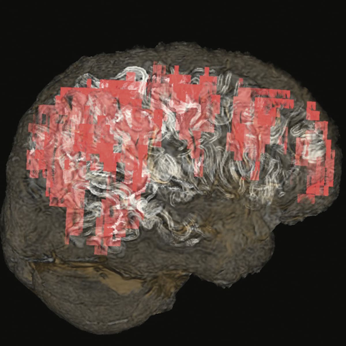 The use of 3D ASL to diagnose Rasmussen’s encephalitis in pediatrics