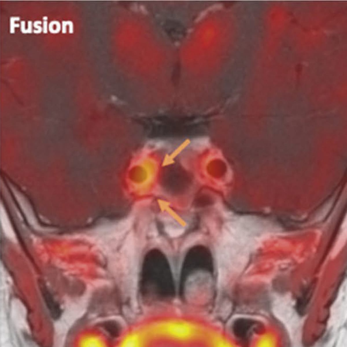 [18F]FET PET/MR for the detection of pituitary microadenoma