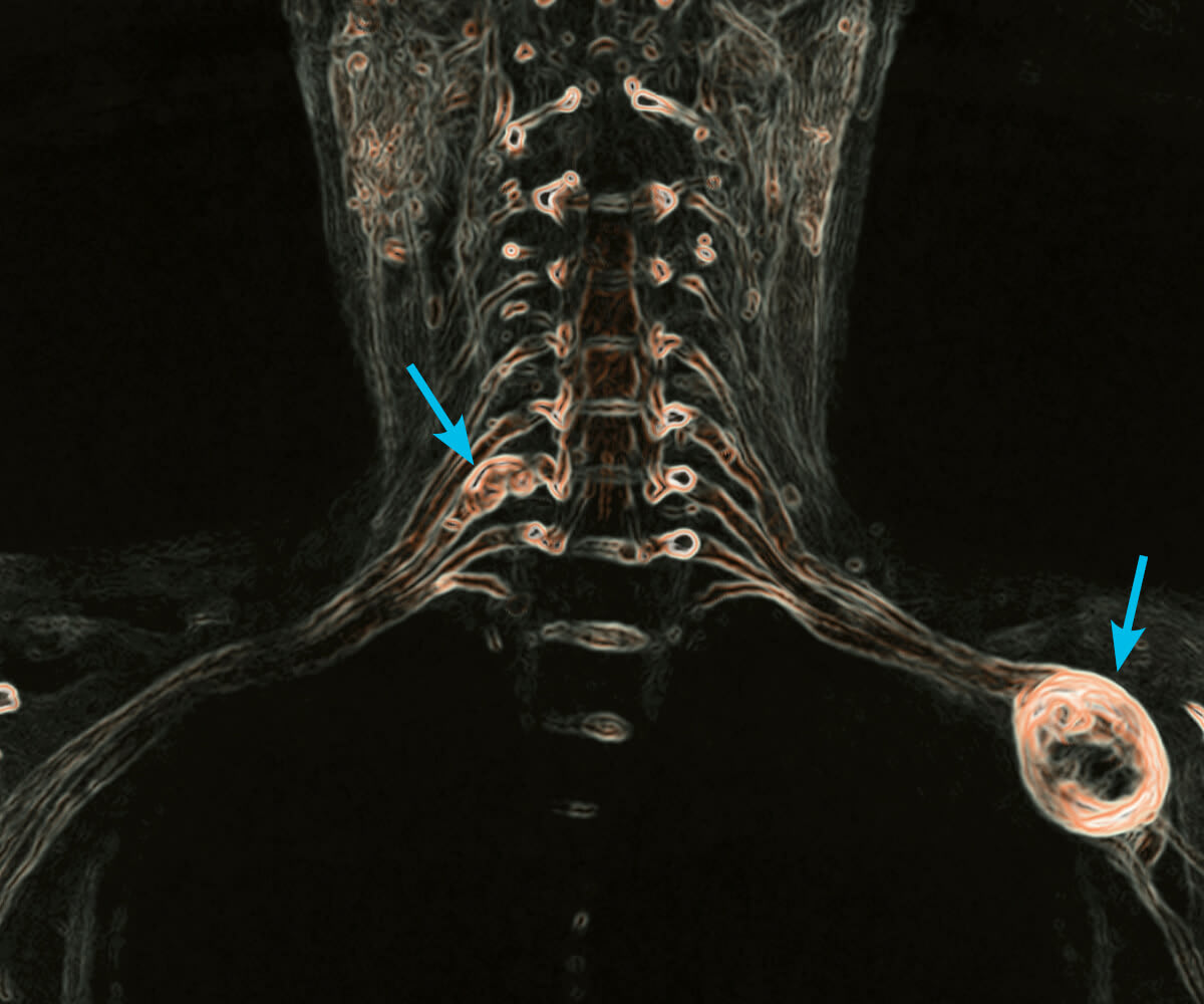 SIGNA™Works AIR™ Edition gallery: Chest or thoracic imaging